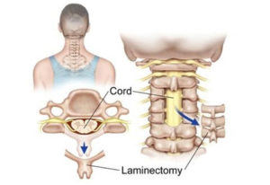 Laminotomy Vs Laminectomy - Which One to Choose?