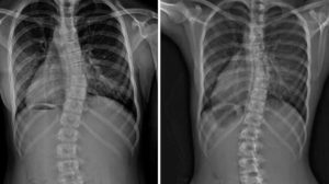Thoracic Dextroscoliosis and Thoracolumbar Dextroscoliosis