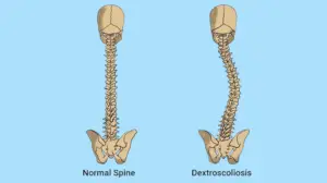 Dextroscoliosis: Definition, Causes, Symptoms, and Treatment