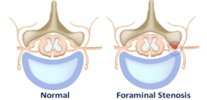 Foraminal Stenosis or Foraminal Narrowing - All You Need to Know
